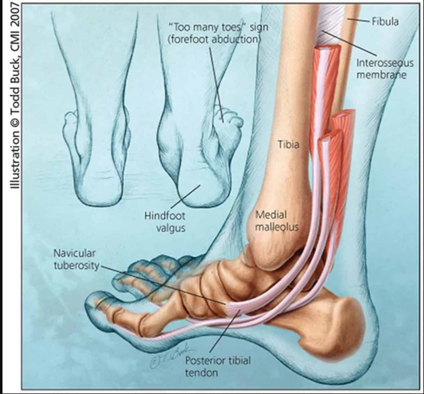 Dance Injuries Posterior Tibial Tendonitis BodyTree Ballet